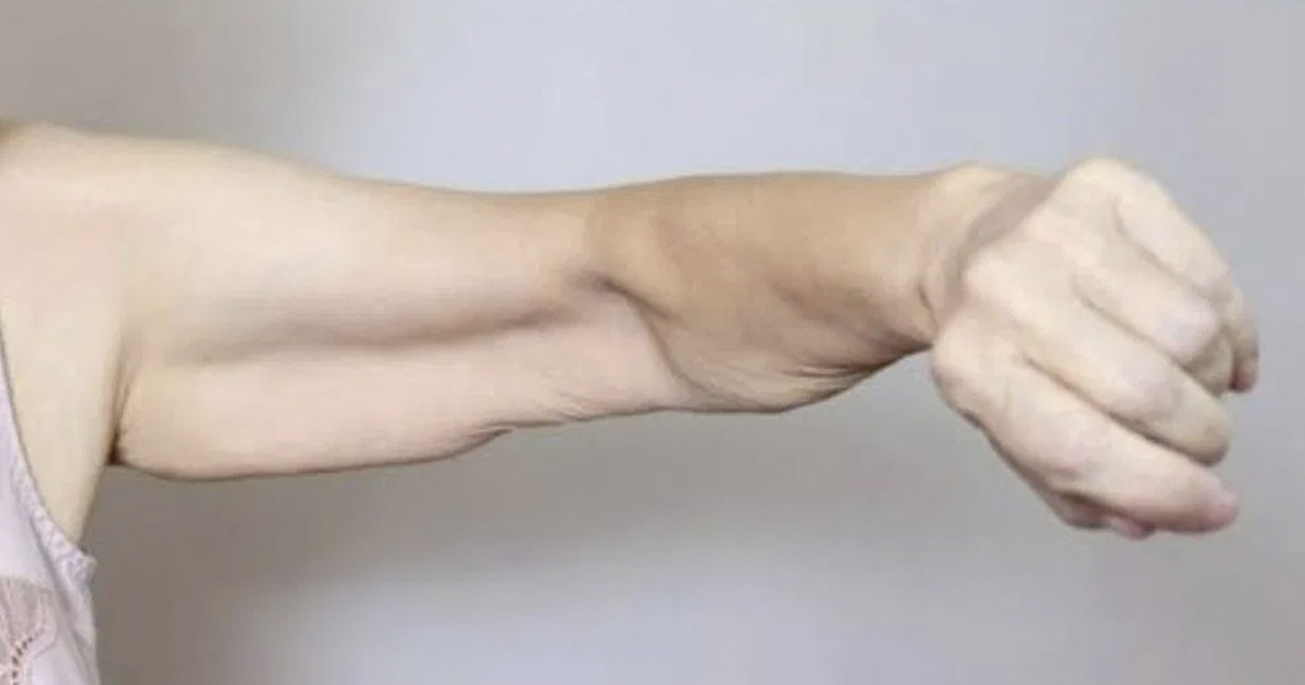 What Is Sarcopenia? Causes, Risk Factors, and How to Manage It