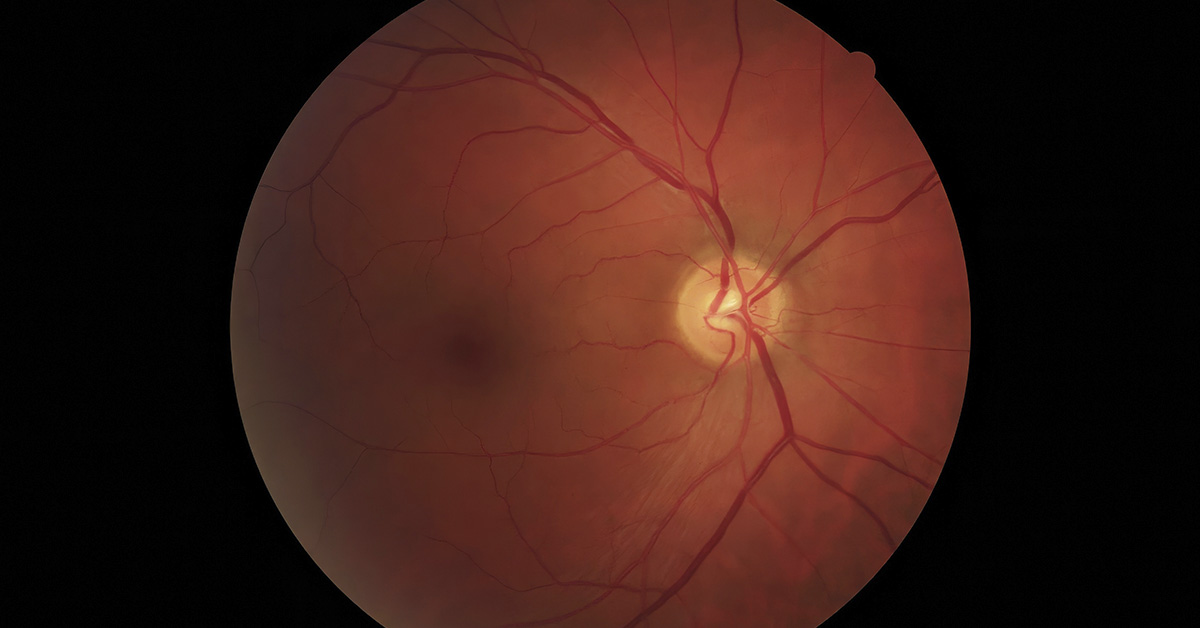 Retinal Degeneration May Be Treated With Drug Originally Developed for ...