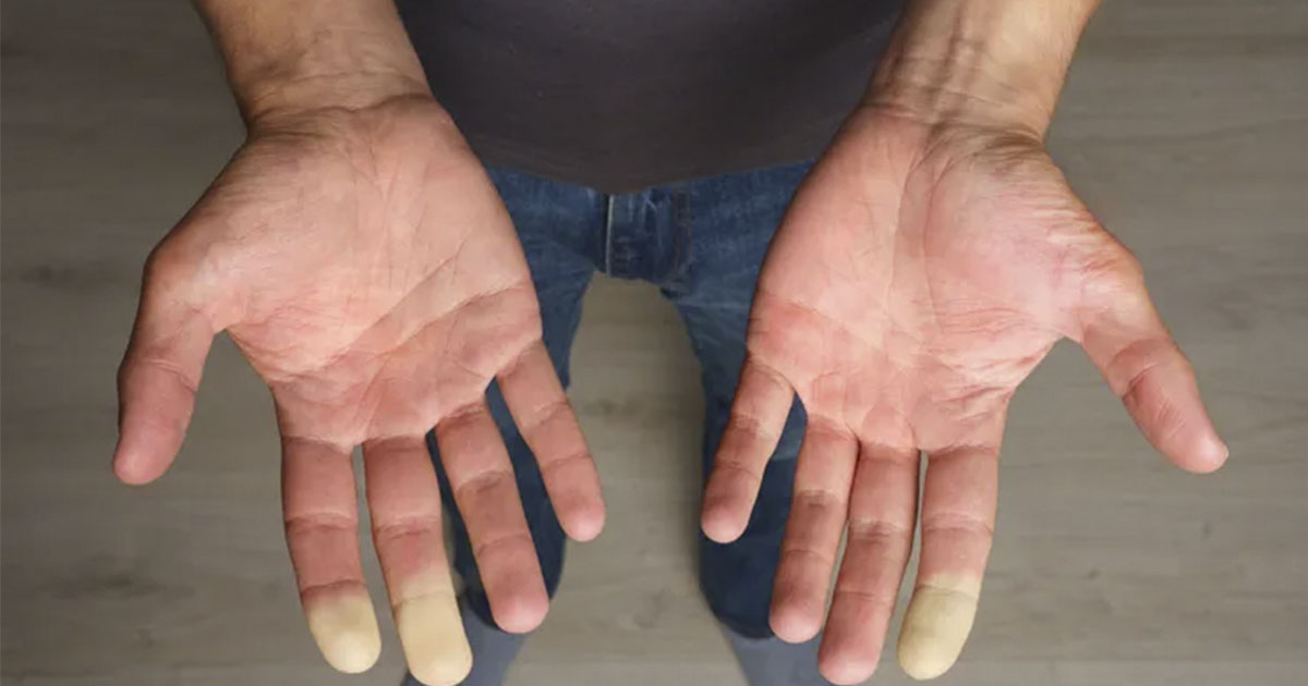 These Unexpected Rheumatoid Arthritis Symptoms Could Be Easy to Miss